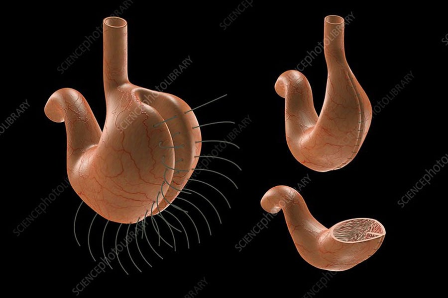 Gastric Plication پلیسه معده - دکتر عبدالعلی رازقیان